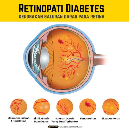 Retinopati Diabetes Salur Darah Retina - DOKTOR SAKIT KRONIK